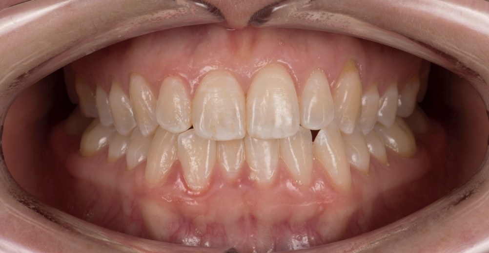 Class I – Crowding, Shallow Overbite (SureSmile® Aligners) USA