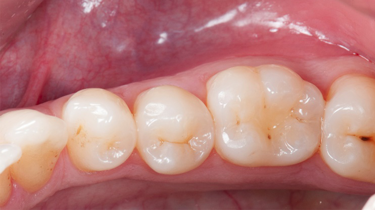 Replacing Class Ii With Recurrent Caries Dentsply Sirona South Africa