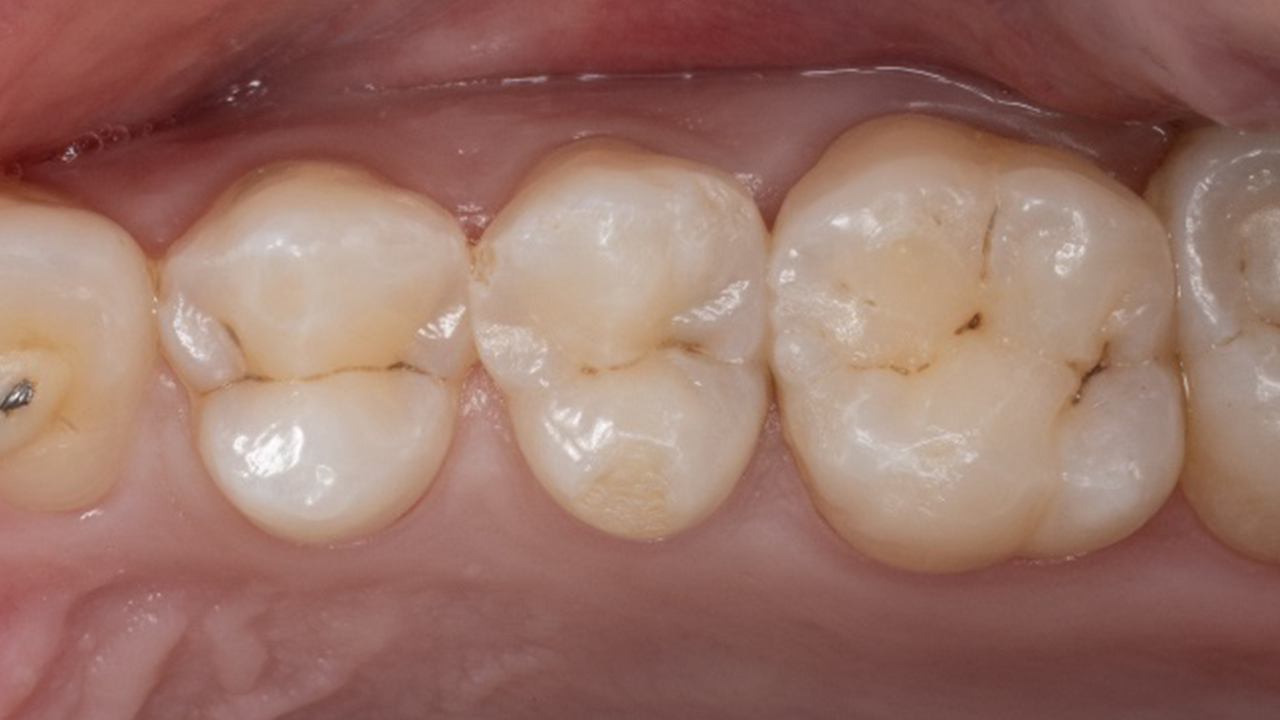 Efficient Direct Restoration of Multiple Cavities in One Upper Quadrant ...