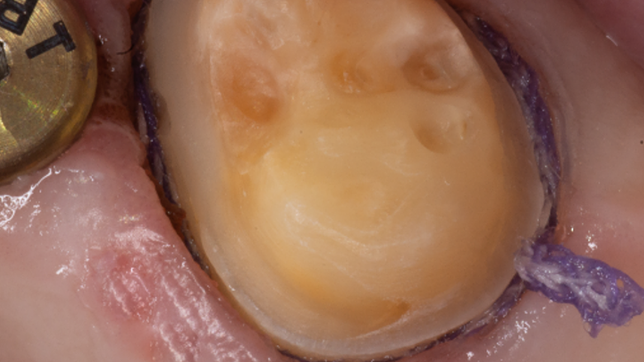 Single-Unit Crown Tissue Management | Dentsply Sirona Croatia