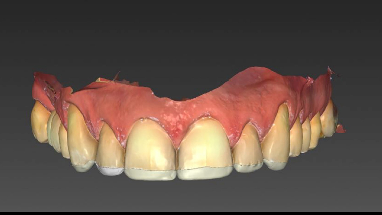 Digital Impressions: Benefits & Use Cases | Dentsply Sirona UK