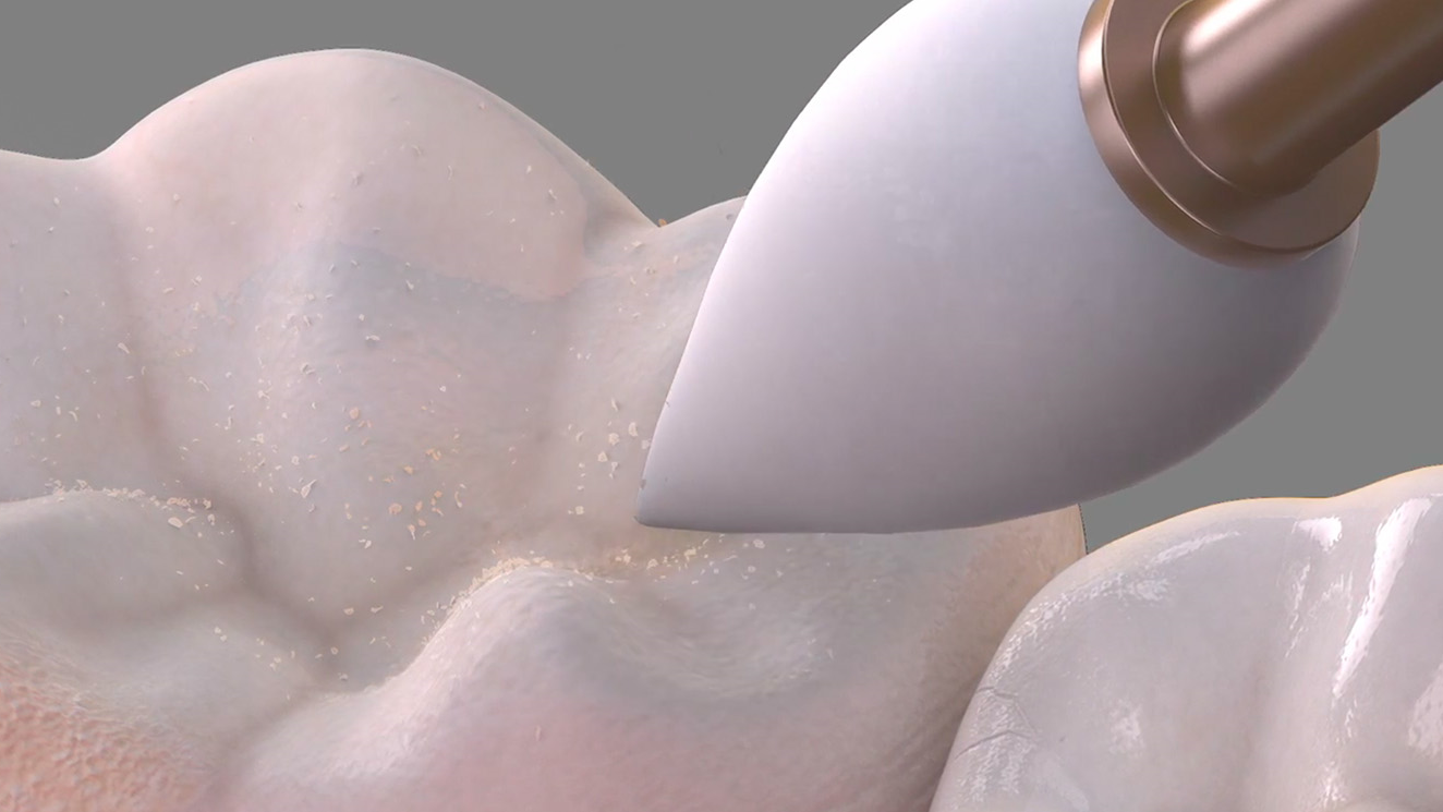 Composite Polishing & Finishing: A Guide | Dentsply Sirona USA