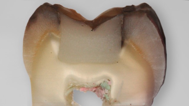 Microfugas: Detección y prevención | Dentsply Sirona ES