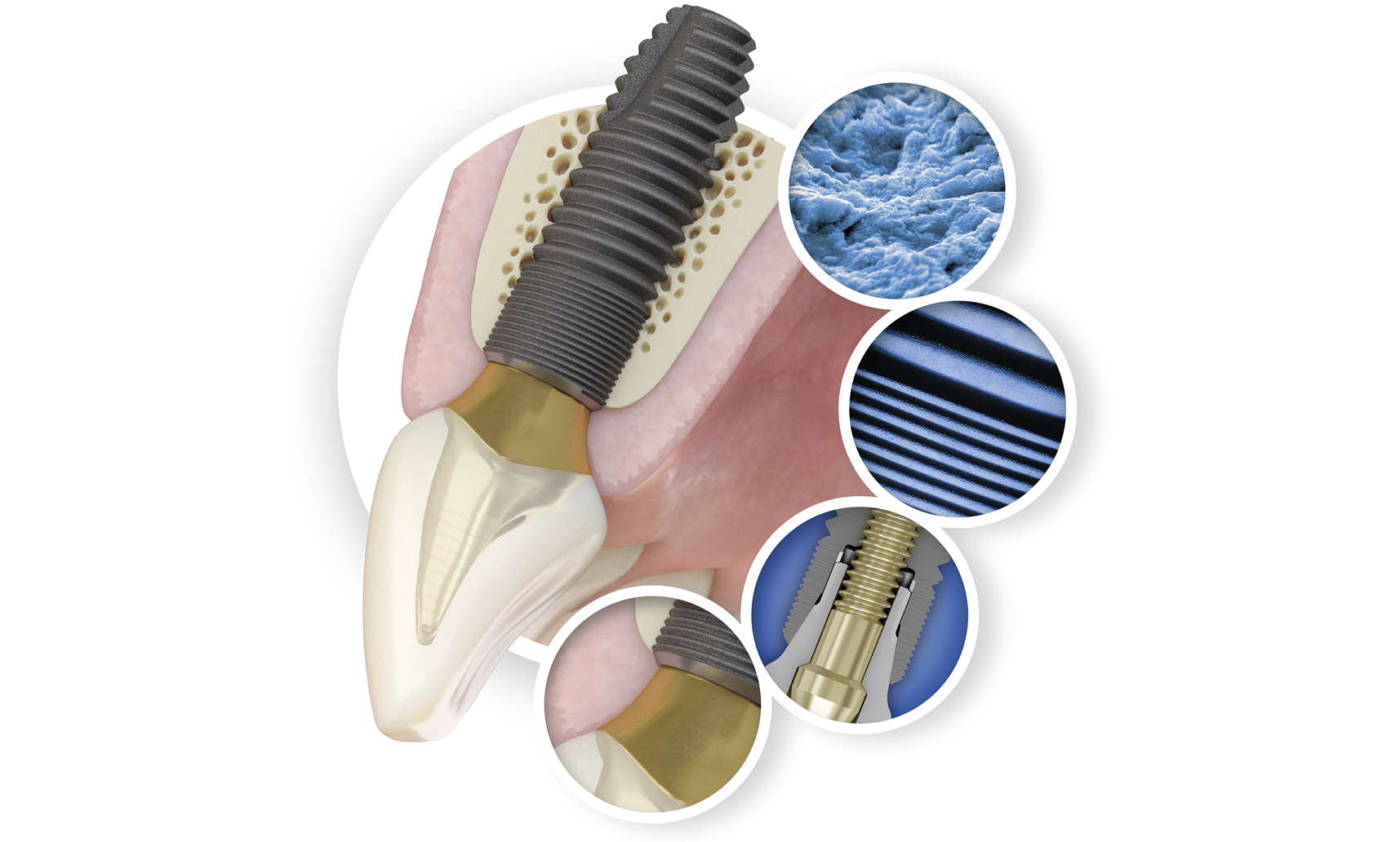 Implantatsysteme | Dentsply Sirona Schweiz